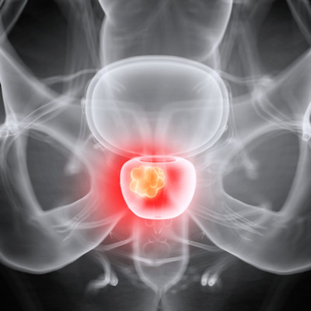 RSIP Vision launches new AI software for prostate MRI analysis ... RSIP Vision launches new AI software for prostate MRI analysis ...