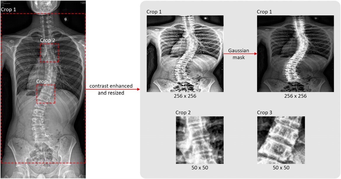 Ai Model Predicts Scoliosis Spinal Curve Progression Radiology Ai